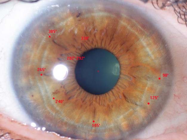 Modern & Multidimensional Iridology: Indented Lacuna Intercept With ...