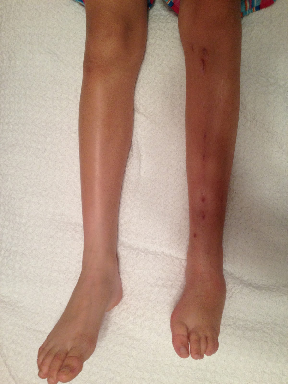 fibular hemimelia leg lengthening: December 2012