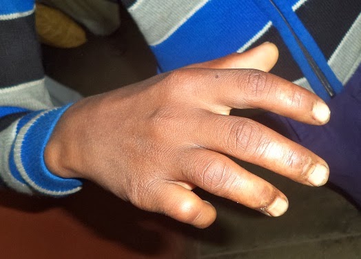 The Learner: Post-burn contracture - Hand