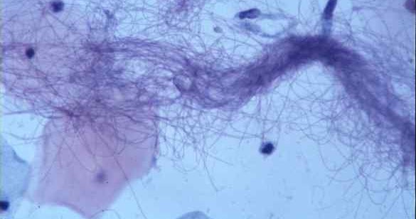 Citología Exfoliativa Mérida: Leptothrix sp. en muestras de Papanicolaou