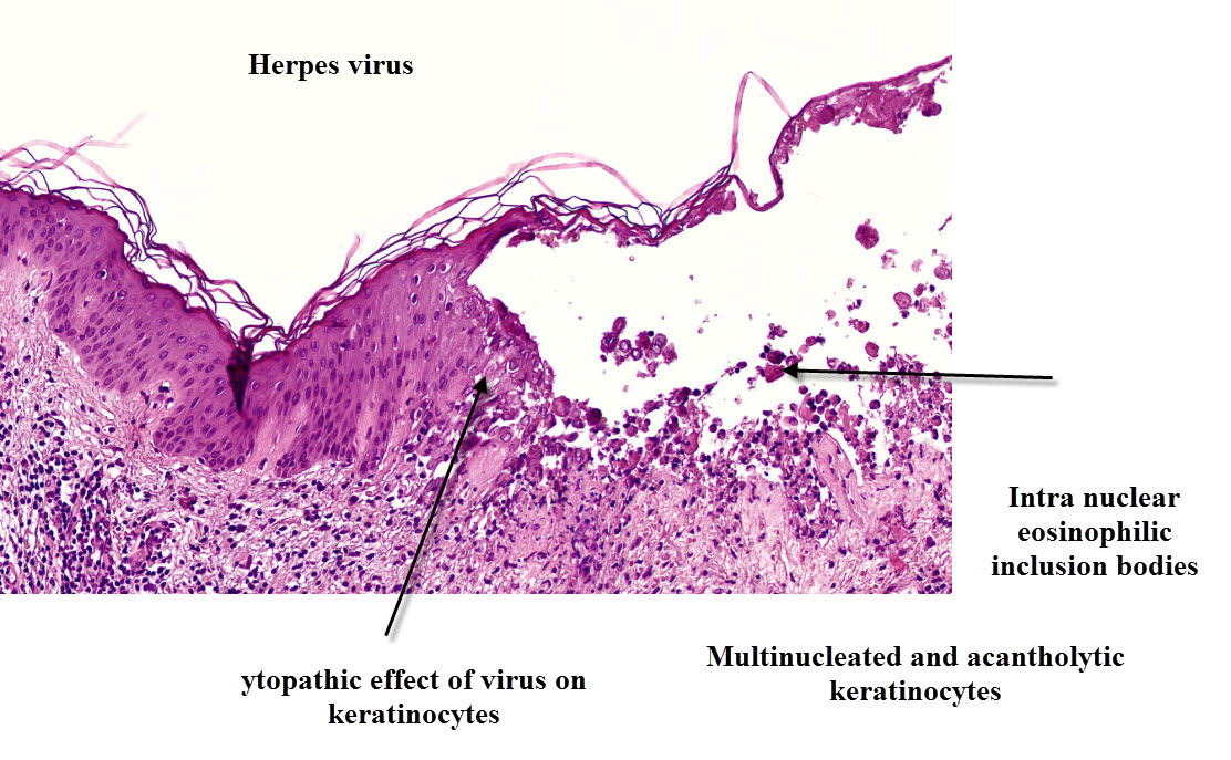 Dermatopathology Made Simple - Inflammatory: Pustular Reaction Pattern