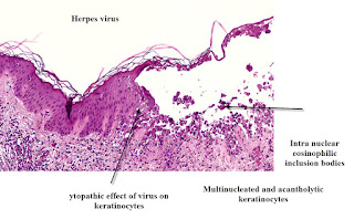 Dermatopathology Made Simple - Inflammatory: Pustular Reaction Pattern