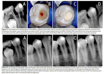 PDF: Apexogenesis treatment with mineral trioxide aggregate: long-term ...