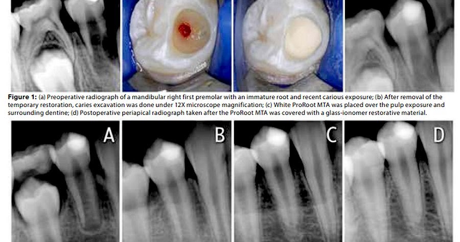 PDF: Apexogenesis treatment with mineral trioxide aggregate: long-term ...