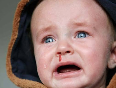 Epistaxis/Nosebleed Causes, Symptoms, & Treatment - All Health Clue