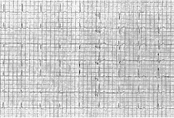 Gambaran Tracking EKG yang Normal