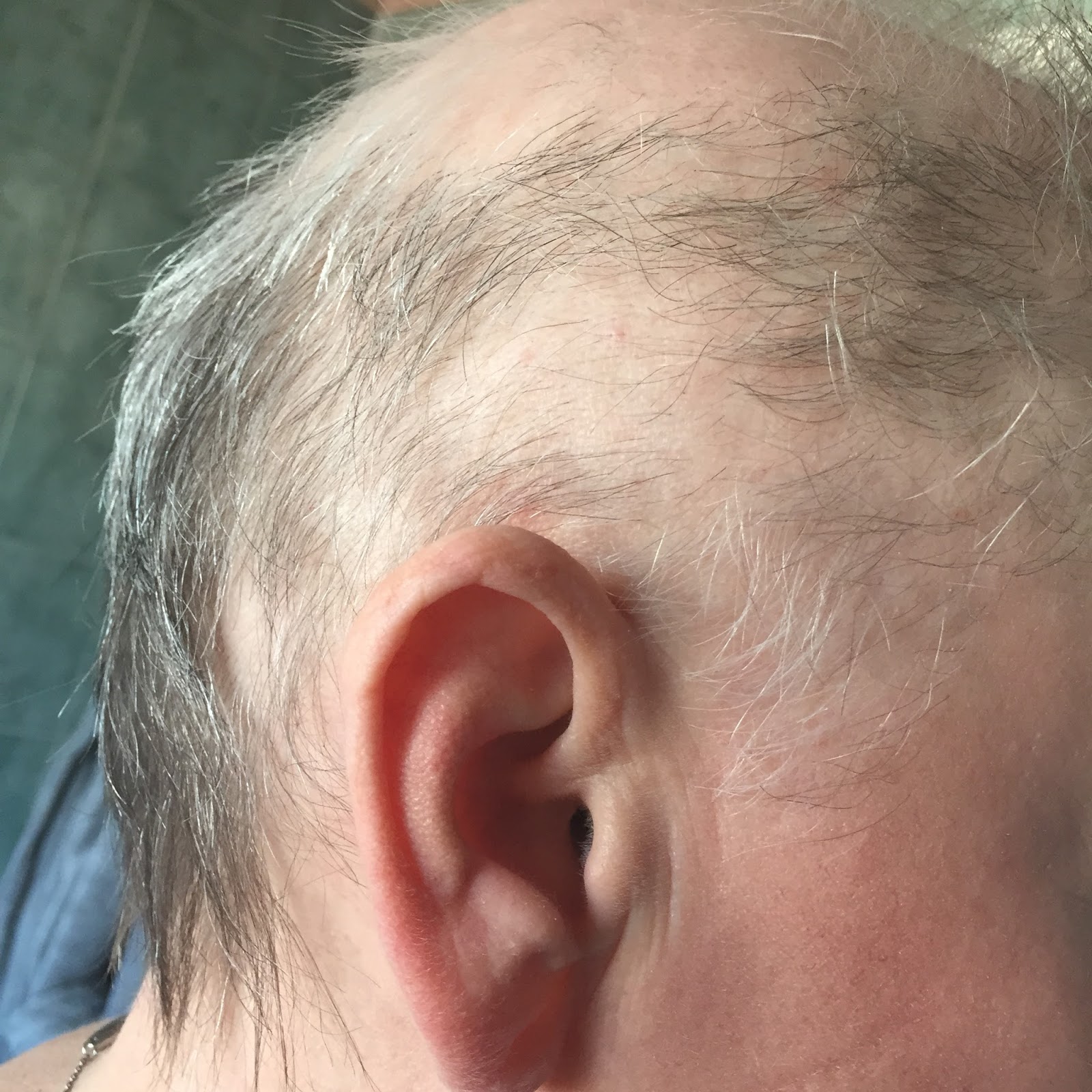 MITT LIV MED ALOPECI - ALOPECIA: RAKA ELLER INTE RAKA...?
