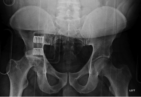 Case of the Month: Fracture cases at Harborview Medical Center ...