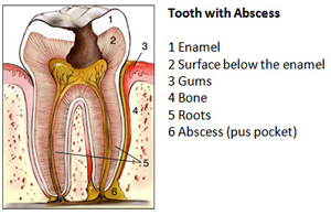 Tooth & Gums: Incision and Drainage