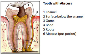 Tooth & Gums: Incision and Drainage