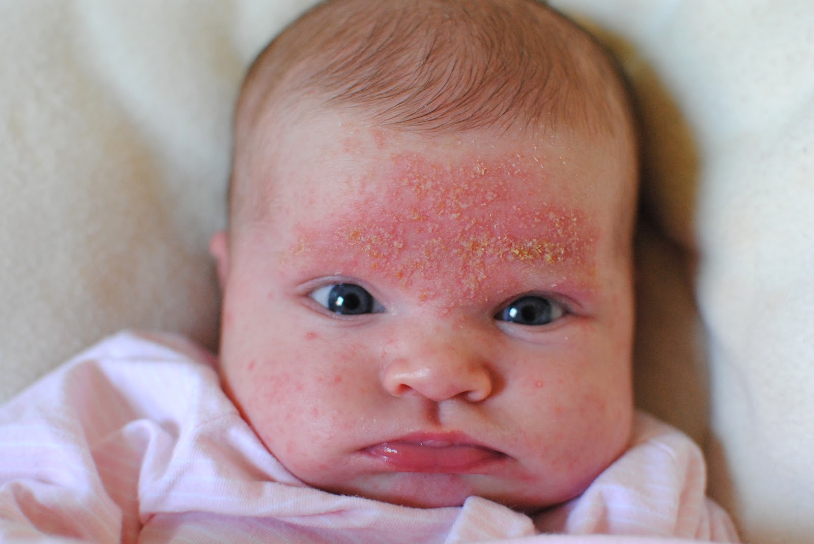 Natural Treatment For Cradle Cap Feathers In Our Nest