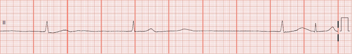 EKG Rhythm Strips 12- ventricular rhythms