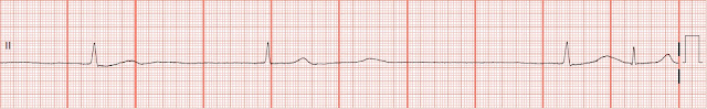 EKG Rhythm Strips 12- ventricular rhythms