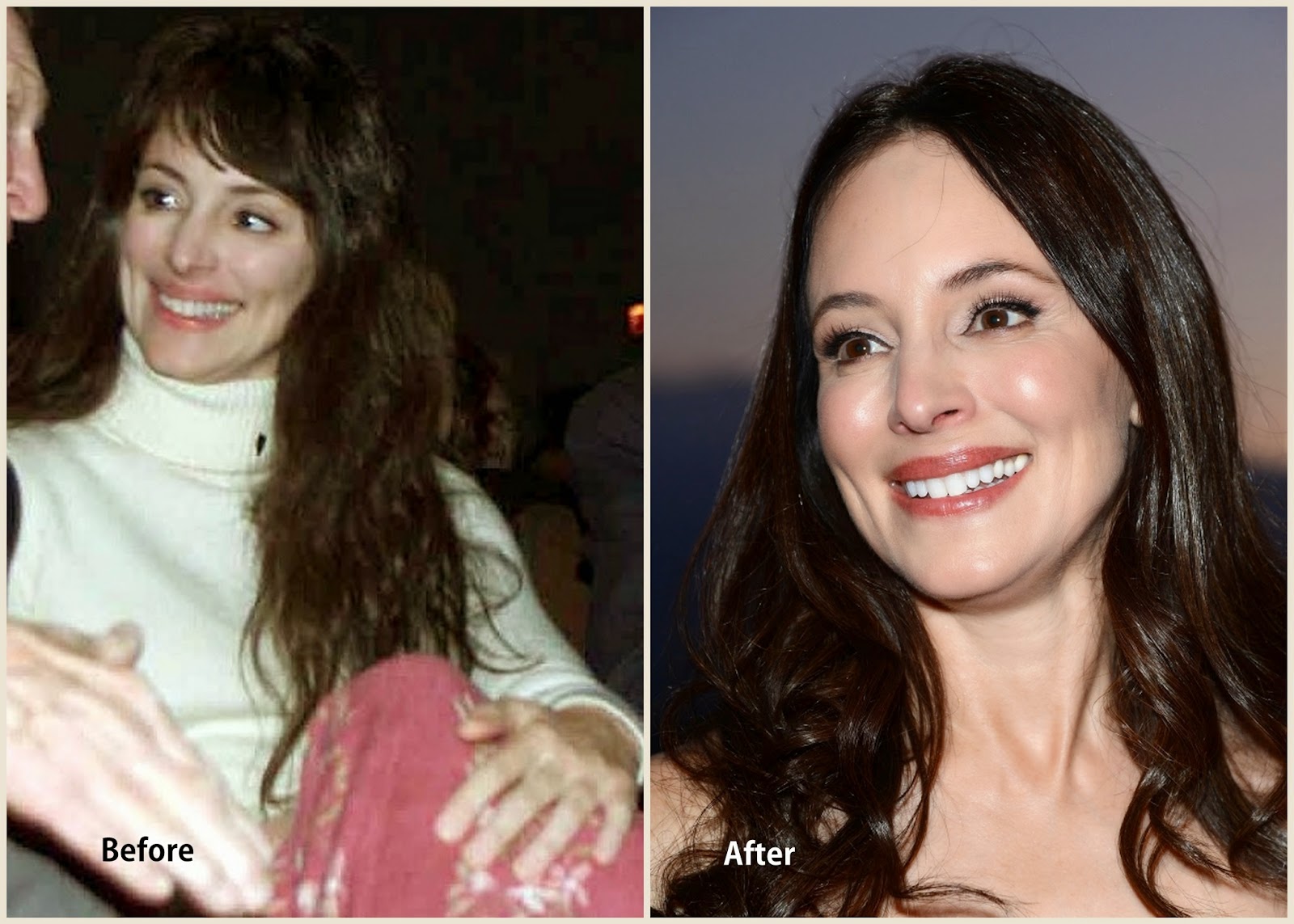 Madeleine Stowe Lip Injections