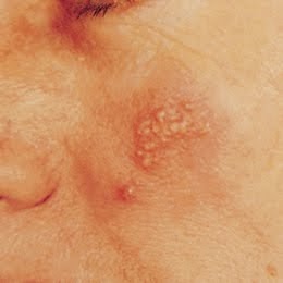 Face Herpes Symptoms And Treatments: Herpes Simplex On The Face - Where ...