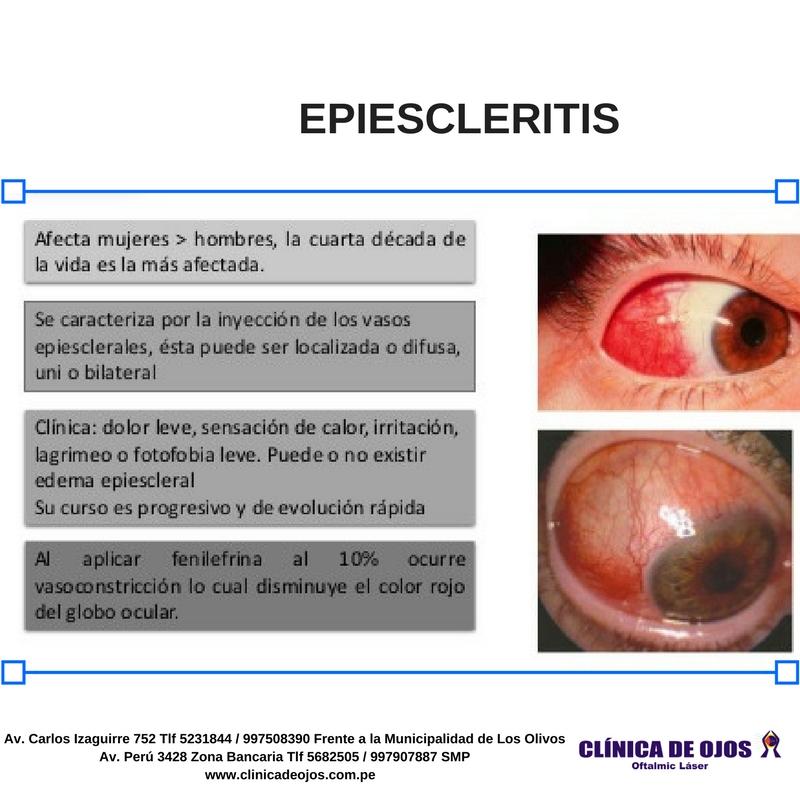 Clínica de Ojos Oftalmic Láser: EPIESCLERITIS