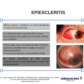 Clínica de Ojos Oftalmic Láser: EPIESCLERITIS
