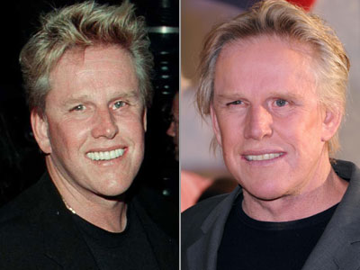 Male Celebrity Plastic Surgery