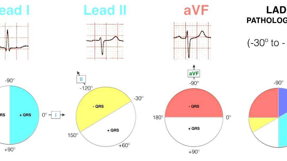 Right axis deviation