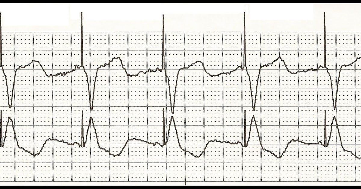 Float Nurse: EKG Rhythm Strip Quiz 100: Paced rhythms