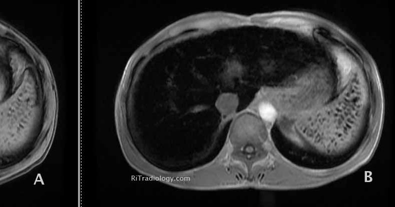 RiT radiology: Hemochromatosis