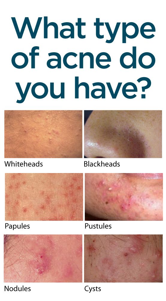Types of Acne Scars