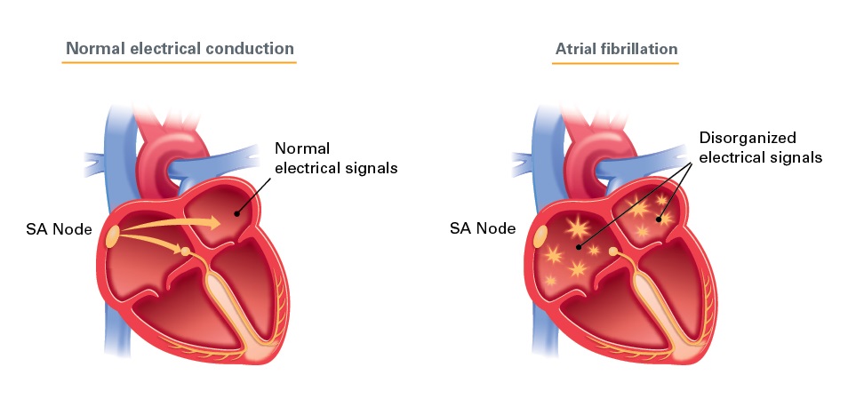 Sick Sinus Syndrome In Heart Disease RINO HEALTH sick-sinus-syndrome-in-heart-disease-rino-health