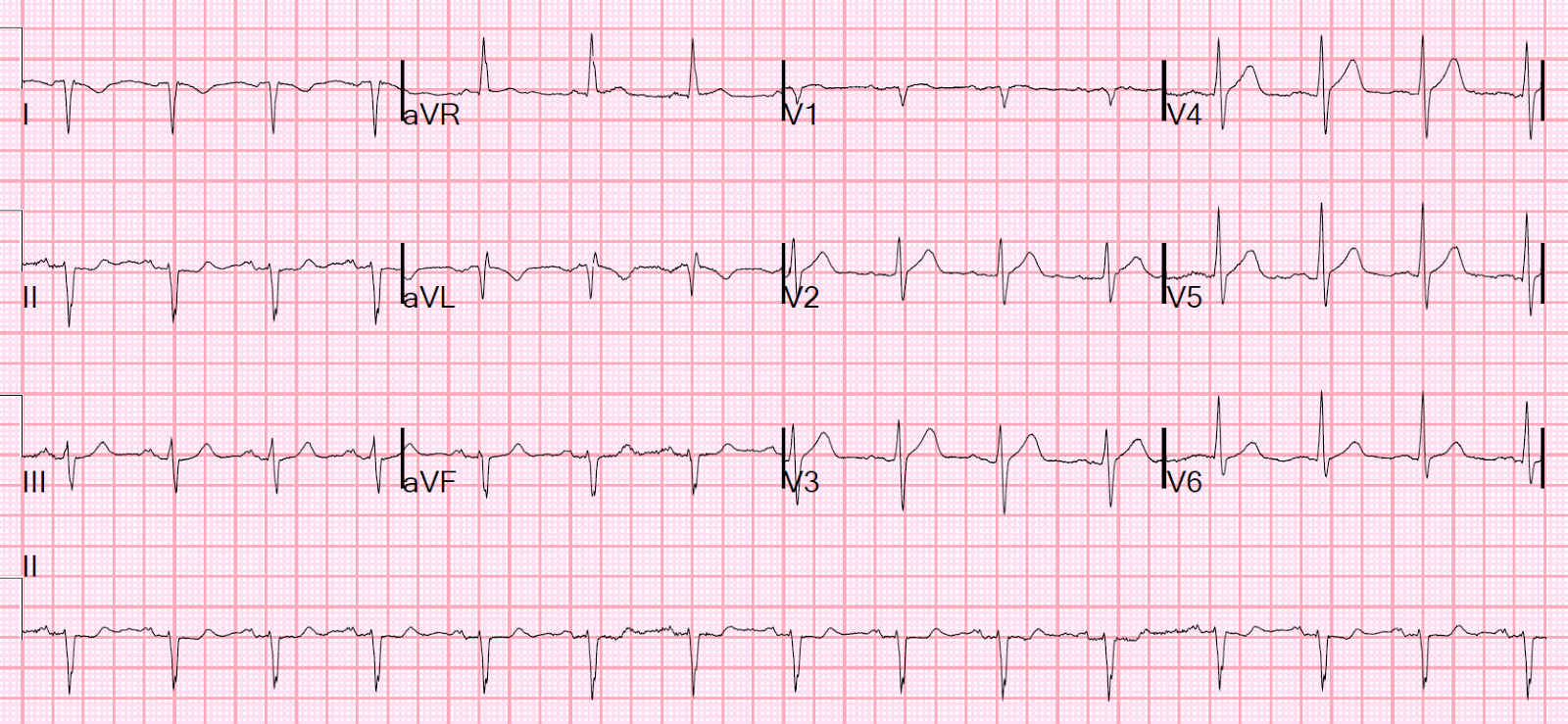 Dr. Smith's ECG Blog: A Middle-Aged Man with crescendo angina