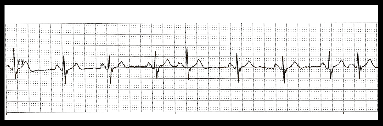 Practice Rhythm Strips 287