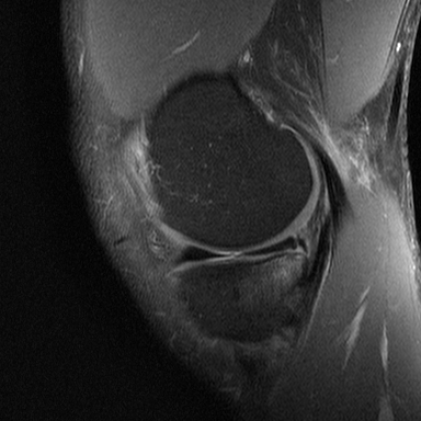 Term of the day-Meniscal Flounce - Sumer's Radiology Blog