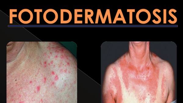 Medicina III - Fotodermatosis | USMP FN Archivos