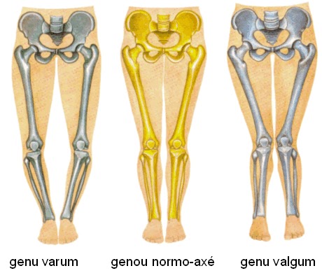 Nuestro esqueleto: Miembro inferior: Genu varum y genu valgum