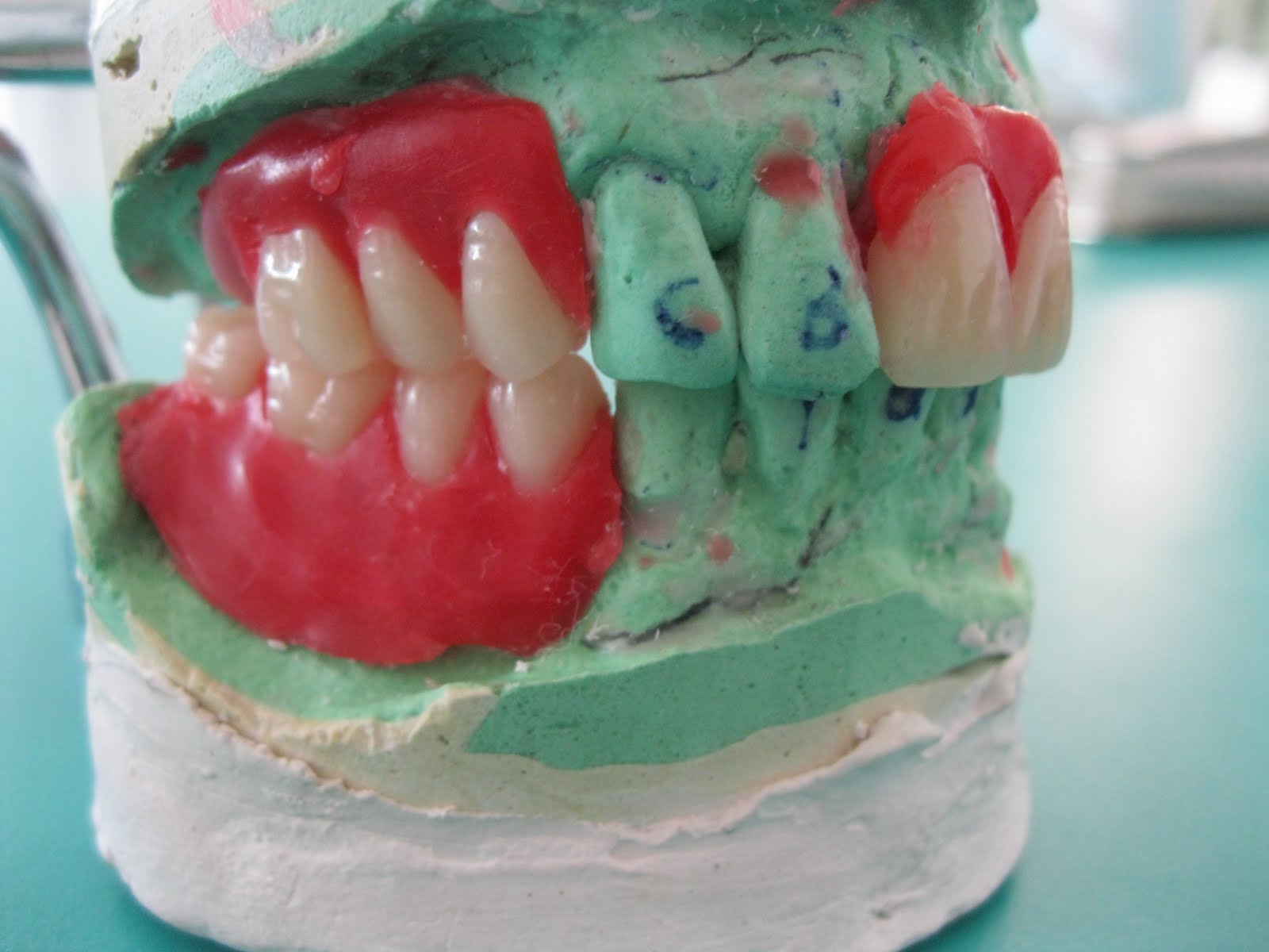 DENTO CARE DENTAL CLINICS: FLEXIBLE DENTURES as IMMEDIATE DENTURE