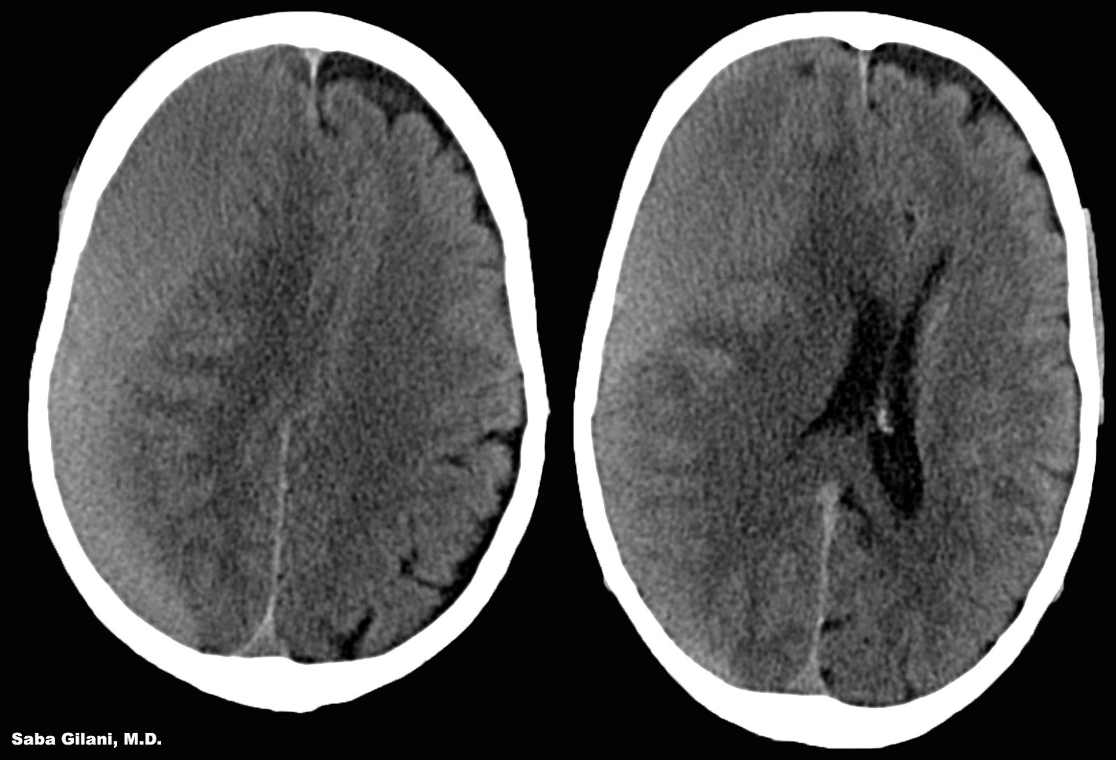 Chronic Subdural Hematoma Mri Wrocawski Informator Internetowy Wrocaw Wroclaw Hotele