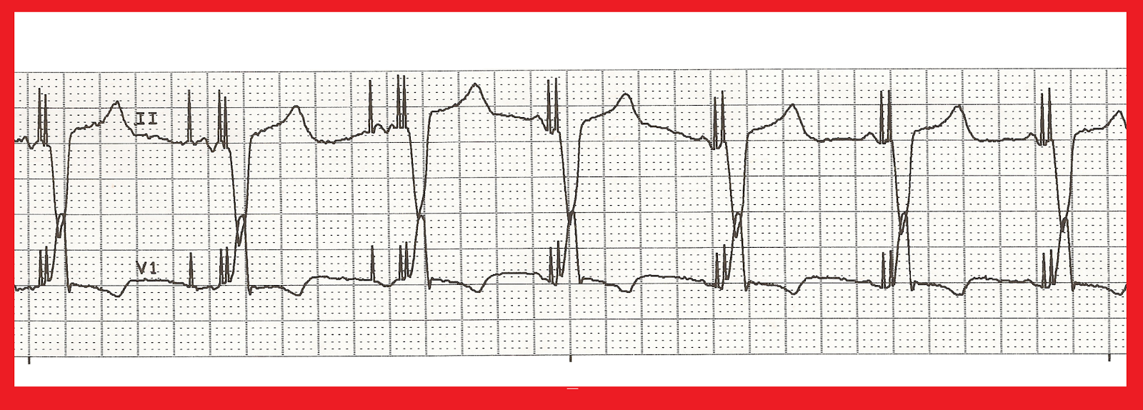 Practice Rhythm Strips 252