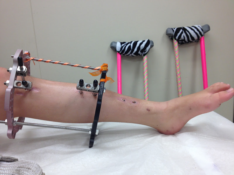 fibular hemimelia leg lengthening: Officially scheduling fixator removal