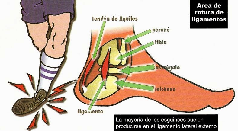 ESGUINCE DE TOBILLO...... CADENA LESIONAL (VISIÓN OSTEOPÁTICA ...