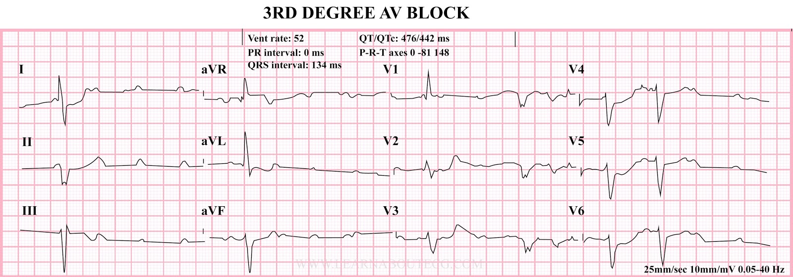 ECG Educator Blog