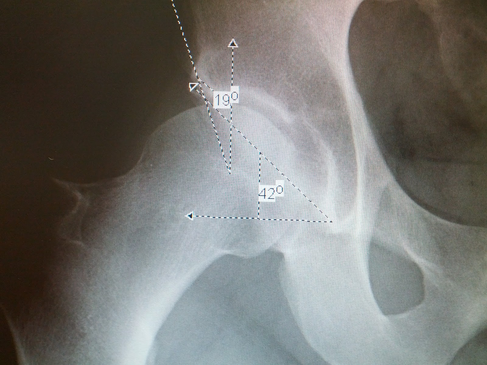 Hip Labral Tear Repair Impingment Fai Arthroscopic Surgery Dysplasia