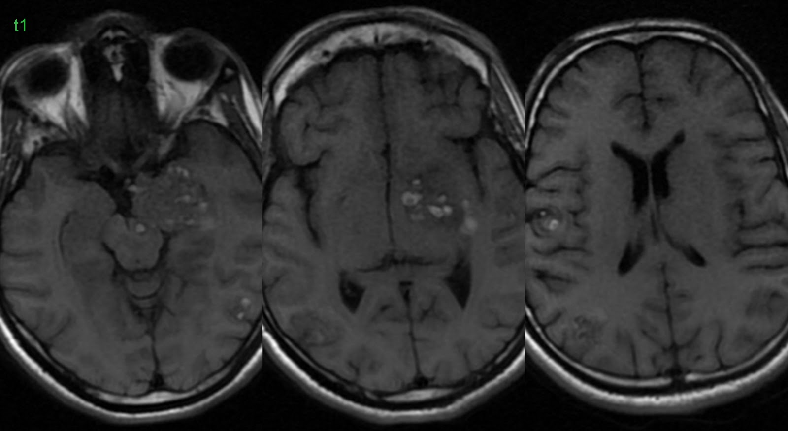 Brain Bleed: Brain Bleed On Mri