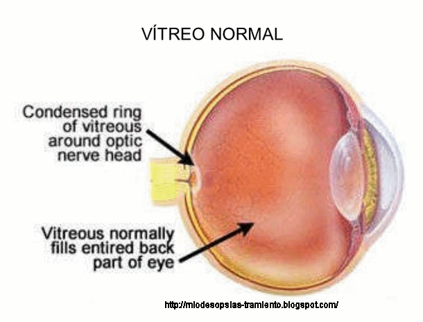 Que son las MIODESOPSIAS, Definición, Causas, Consecuencias ...