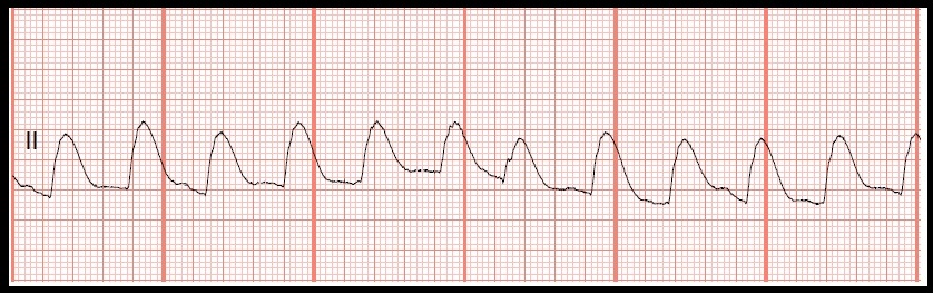 EKG Rhythm Strip Quiz 167