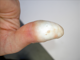 Sword Of Survival: Cold Weather Injuries and Treatment