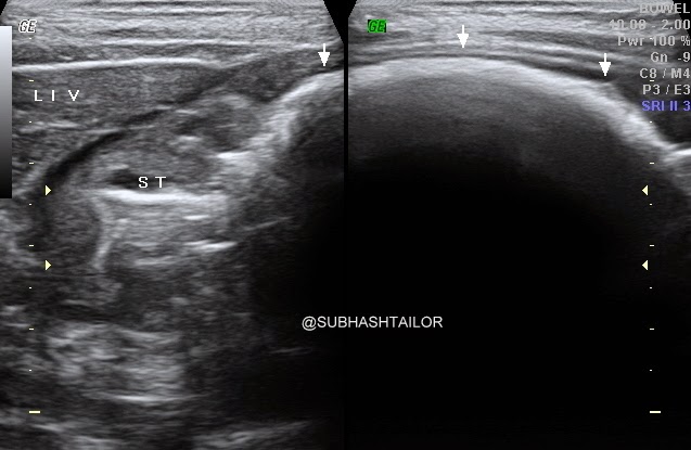SONO DIGEST: GASTRIC TRICHOBEZOAR - an ultrasound diagnosis
