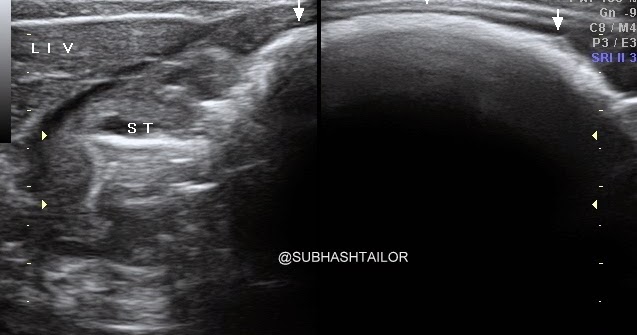 SONO DIGEST: GASTRIC TRICHOBEZOAR - an ultrasound diagnosis
