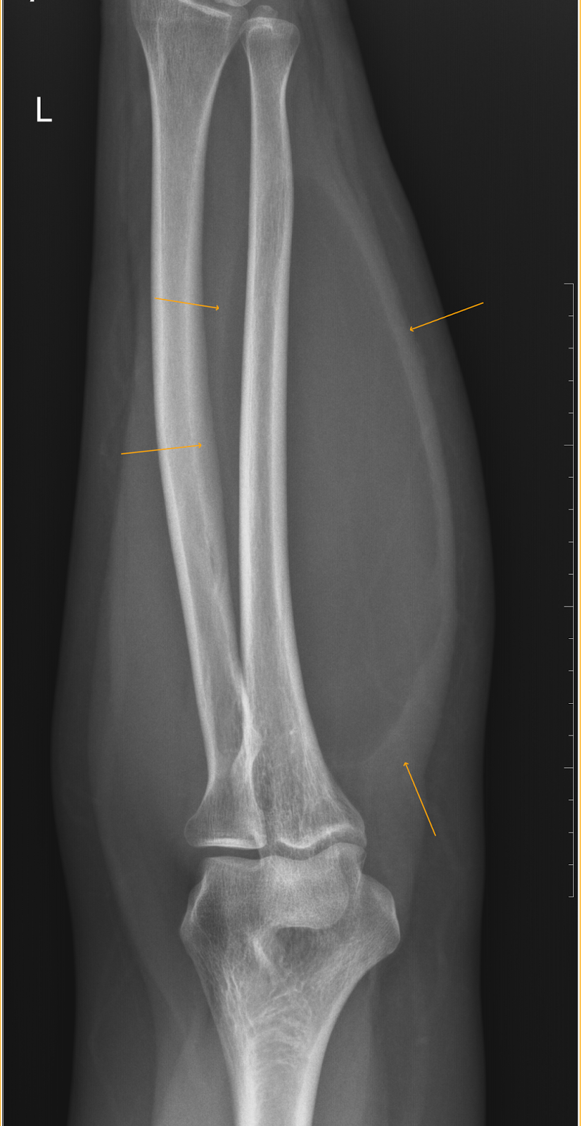Intramuscular Lipoma Plain Xray Sumers Radiology Blog