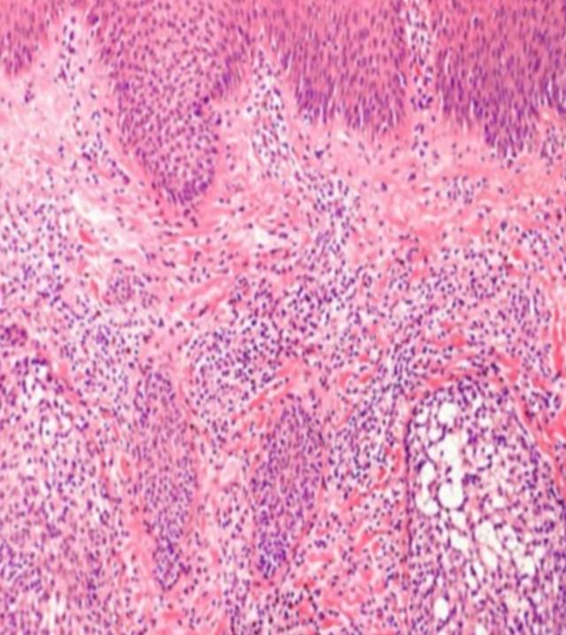 Dermatopathology Case 97