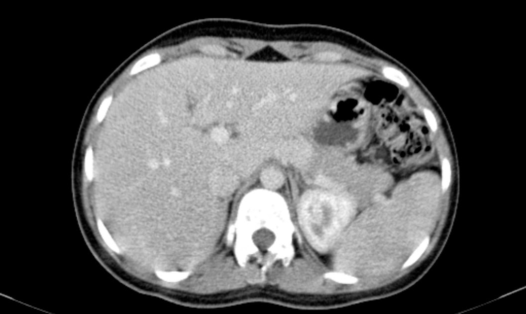 Ultimate Radiology : Pseudolesion : Papillary Process of Caudate Lobe