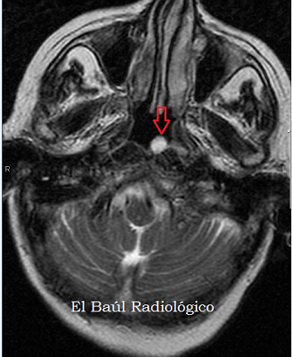 El Baúl Radiológico: QUISTE DE TORNWALDT. BURSA RINOFARÍNGEA (Tornwaldt ...