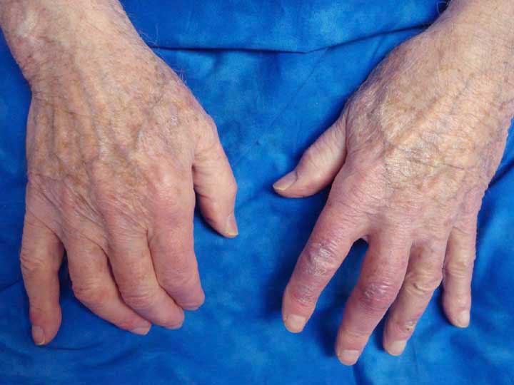 VIRTUAL GRAND ROUNDS IN DERMATOLOGY 2.0: Dermatomyositis?